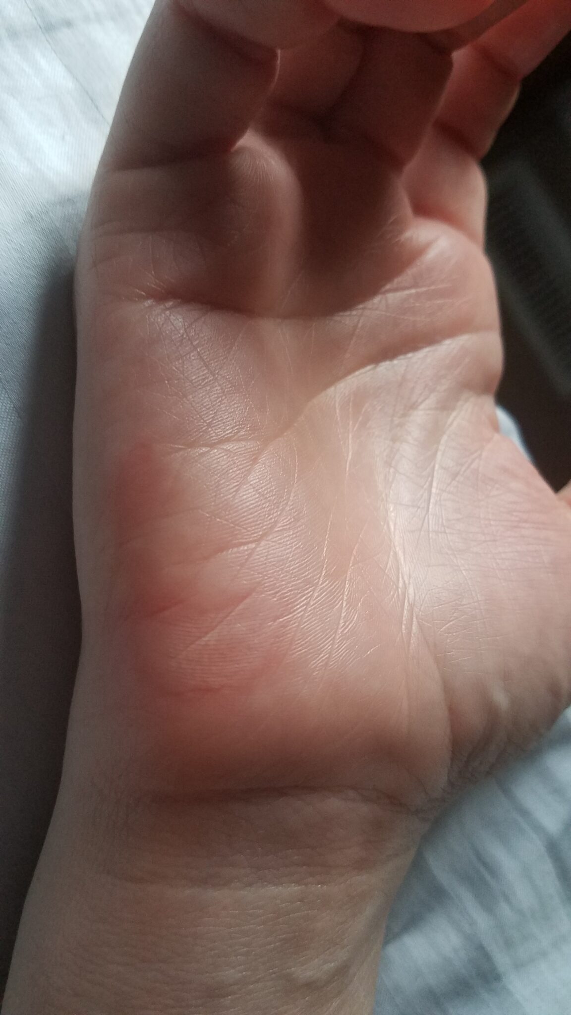 Kitchen First Aid Tip for Burns – B4 and Afters use Mustard