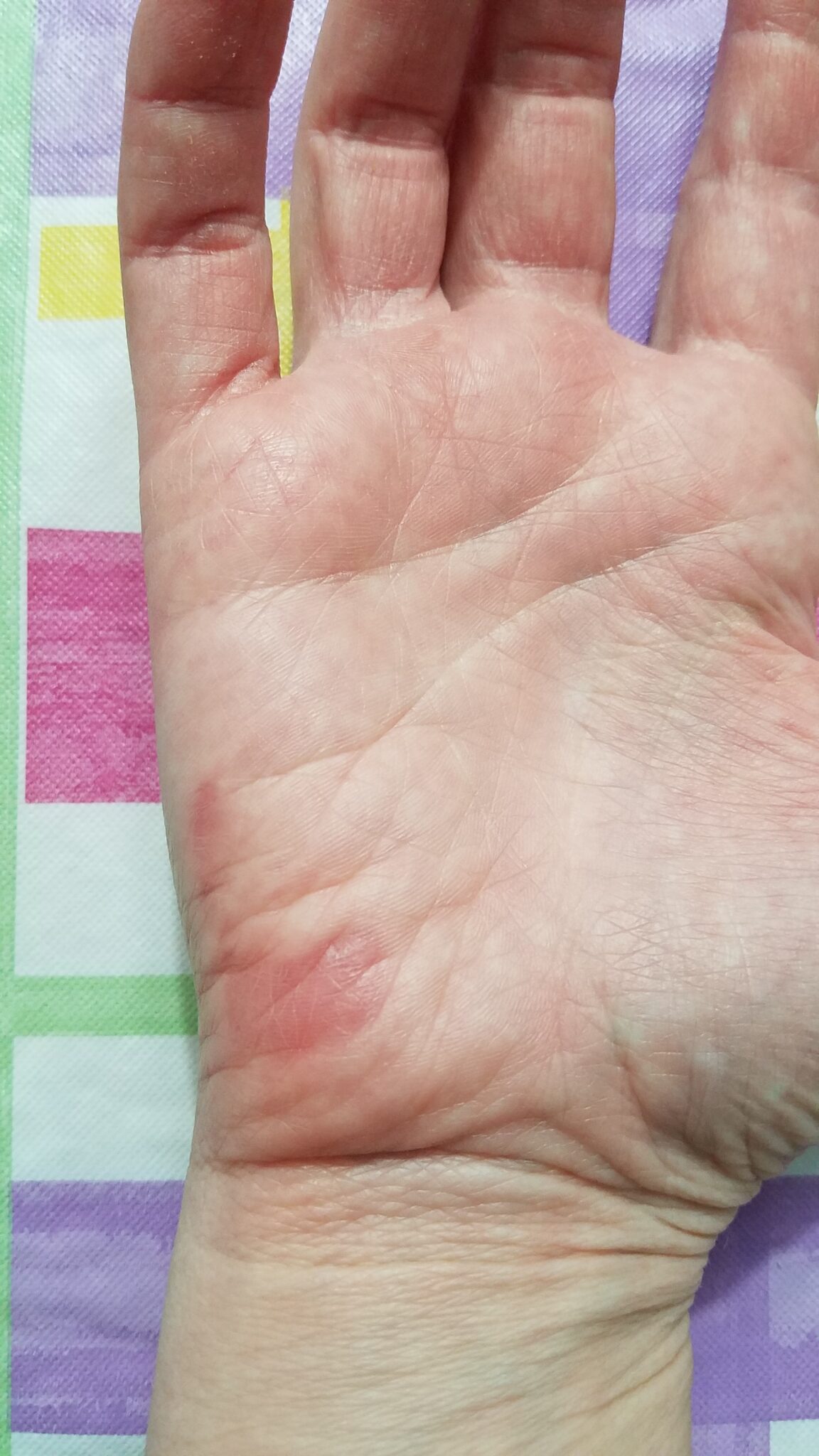 Kitchen First Aid Tip for Burns – B4 and Afters use Mustard