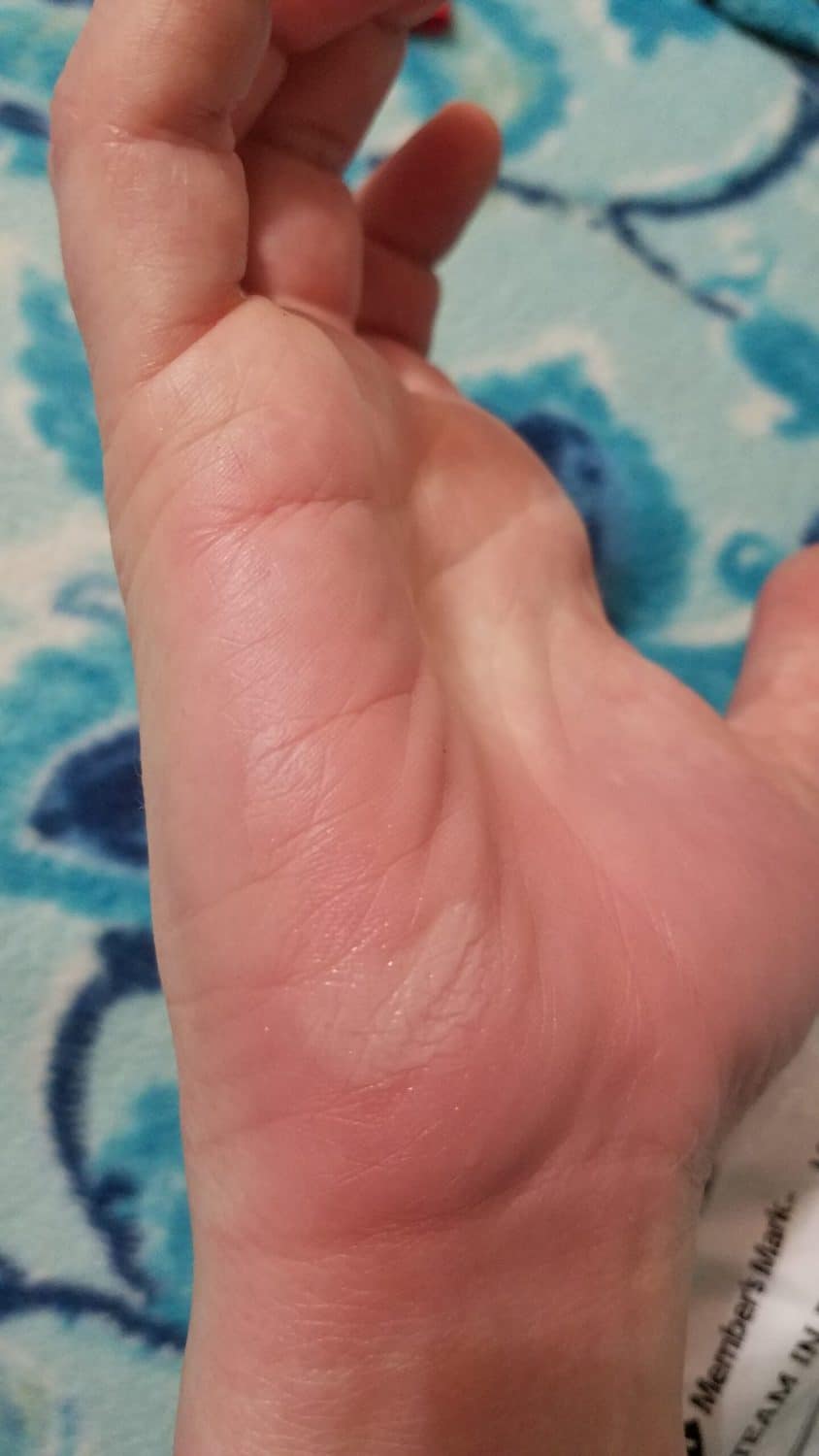 Burned Hand B4 And Afters Burned Hand B4 And Afters